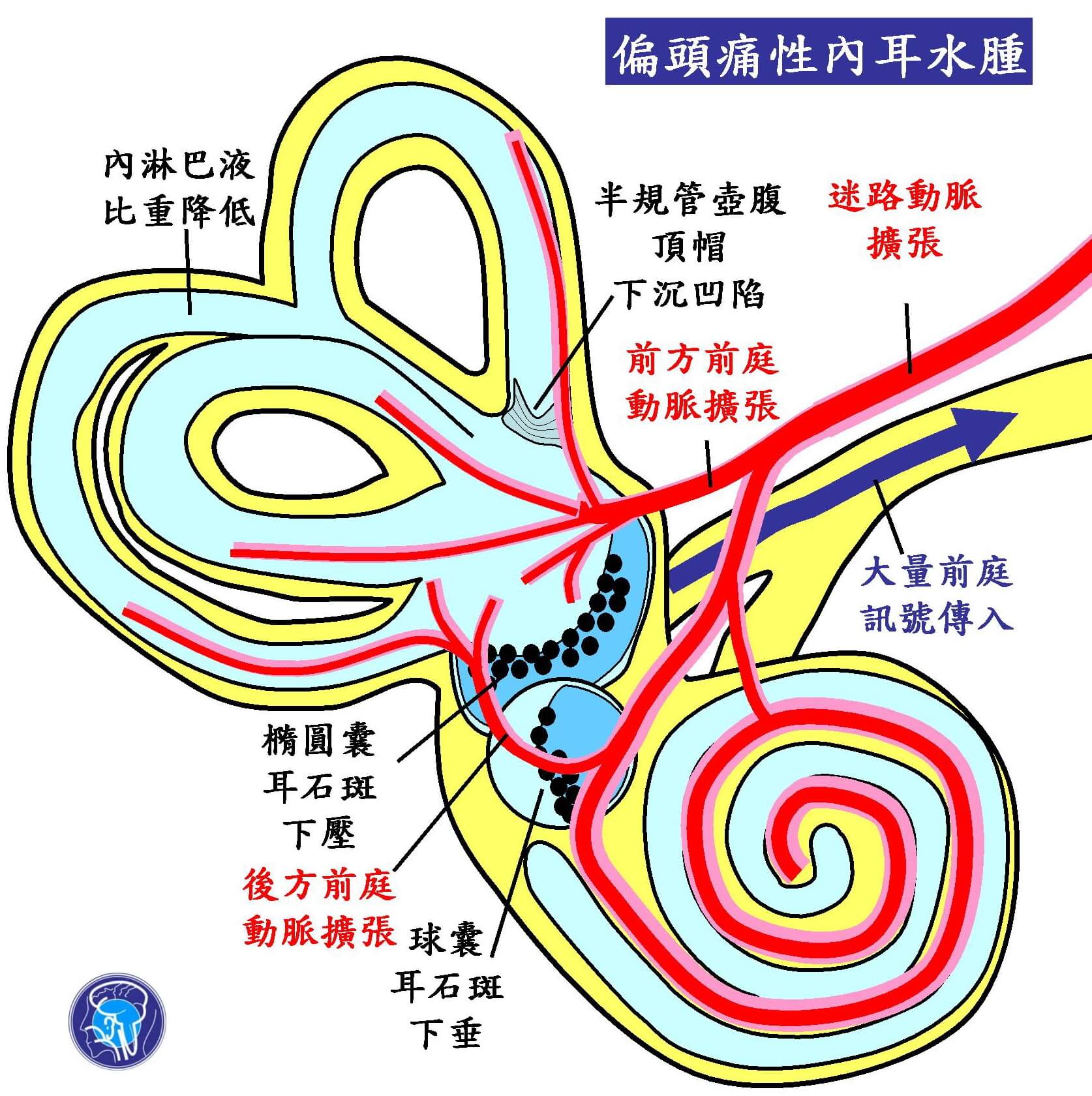 偏頭痛又眩暈？又痛又暈！認識偏頭痛性眩暈症，留意眩暈方向 今健康